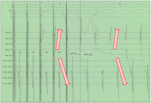 Typisches Vorhofflattern | SpringerLink