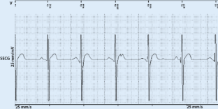 Implantierbarer Loop-Rekorder BioMonitor 2 (Fa. Biotronik) | SpringerLink