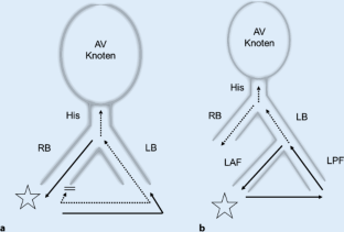 Bundle-Branch-Reentry-VT | SpringerLink