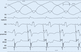 Bundle-Branch-Reentry-VT | SpringerLink