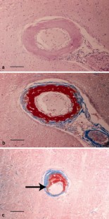 Fibrinoid necrosis of small brain arteries and arterioles and miliary ...