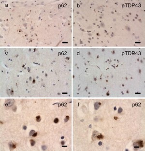 p62 positive, TDP-43 negative, neuronal cytoplasmic and intranuclear ...
