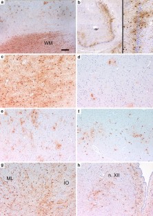 Aging-related tau astrogliopathy (ARTAG): harmonized evaluation ...