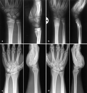 Remodeling capacity and functional outcome of palmarly versus dorsally ...