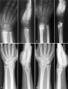 Remodeling capacity and functional outcome of palmarly versus dorsally ...