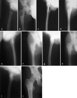 Treatment of femoral neck and trochanteric simple bone cysts | SpringerLink