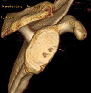 Arthroscopic reconstruction of chronic anteroinferior glenoid defect ...