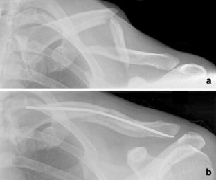 Shaft fractures of the clavicle: current concepts | SpringerLink