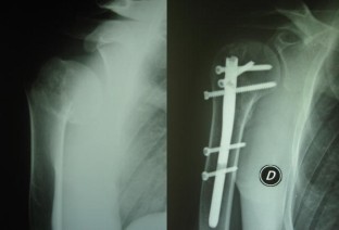 Internal fixation of proximal humerus fractures using the T2-proximal ...