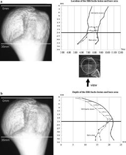 Location of the Hill-Sachs lesion in shoulders with recurrent anterior ...