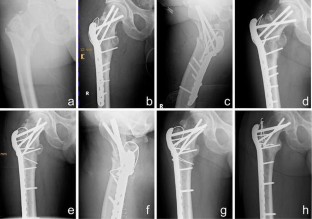 Fixation failure of the LCP proximal femoral plate 4.5/5.0 in patients ...