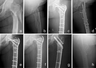 Fixation failure of the LCP proximal femoral plate 4.5/5.0 in patients ...