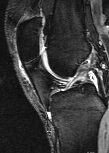 Hoffa’s fat pad impingement treated arthroscopically: related findings ...