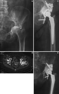 The Burch–Schneider cage for reconstruction after metastatic ...