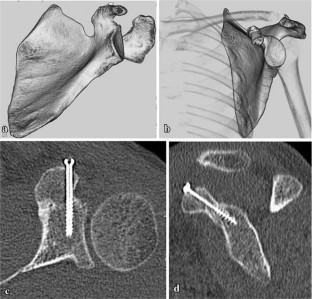Safety screw fixation technique in a case of coracoid base fracture ...