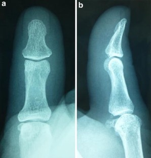 Irreducible dislocation of the thumb interphalangeal joint due to ...