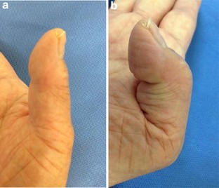 Irreducible dislocation of the thumb interphalangeal joint due to ...