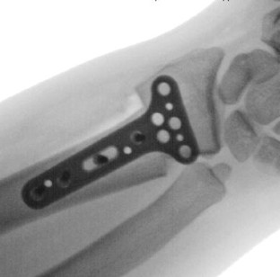 The distal radial decompression osteotomy for ulnar impingement ...