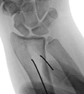 The distal radial decompression osteotomy for ulnar impingement ...