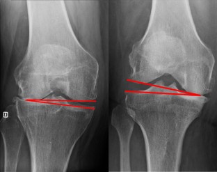 Bone morphotypes of the varus and valgus knee | SpringerLink