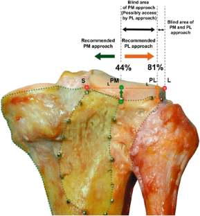 Posterolateral tibial plateau fractures, how to buttress? Reversed L ...