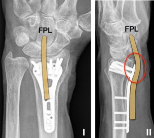 Three-dimensional kinematics of the flexor pollicis longus tendon in ...