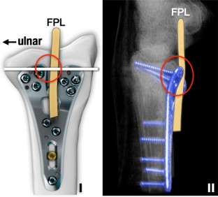 Three-dimensional kinematics of the flexor pollicis longus tendon in ...