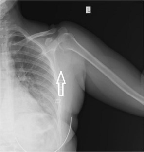 Primary aneurysmal bone cyst of the scapula in adult patient: two case ...