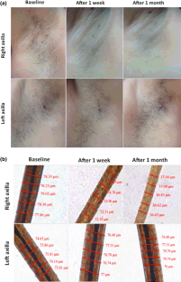 Hair follicle changes following intense pulsed light axillary hair ...