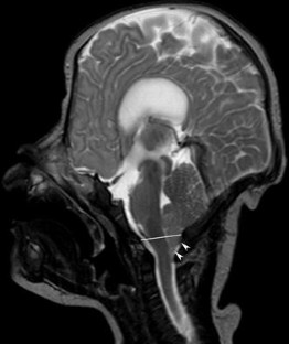 Craniosynostosis: prenatal diagnosis by means of ultrasound and SSSE ...