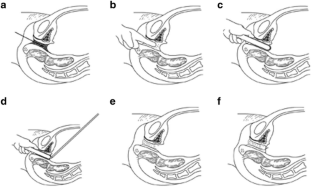 Comparison of improved laparoscopic peritoneal vaginoplasty and gasless ...