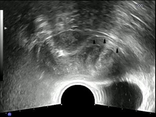 Hysterosalpingo contrast sonography (HyCoSy): let’s make the point ...