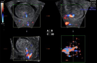 Hysterosalpingo contrast sonography (HyCoSy): let’s make the point ...