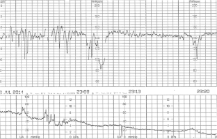 Fetomaternal hemorrhage (FMH), an update: review of literature and an ...