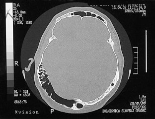 Hyperpneumatization of the temporal, occipital and parietal bones ...
