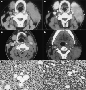 Granulocytic sarcoma (chloroma) presenting as a lateral neck mass ...