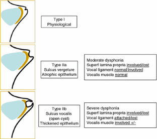 Sulcus vocalis: a review | SpringerLink