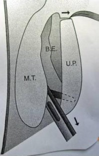 Uncinectomy: Stammberger or swing-door technique? | SpringerLink