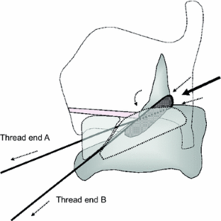 Sling arytenoid adduction | SpringerLink