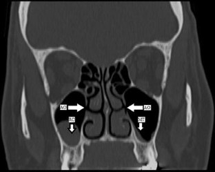 The effect of the presence of the accessory maxillary ostium on the ...