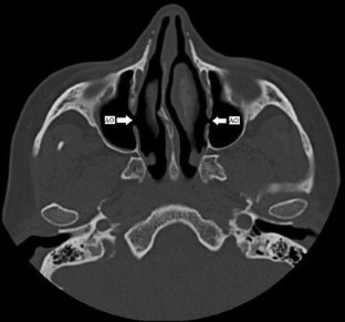 The effect of the presence of the accessory maxillary ostium on the ...