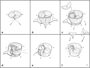 The MO-meatocanalplasty: a modification of the M-meatoplasty to address ...