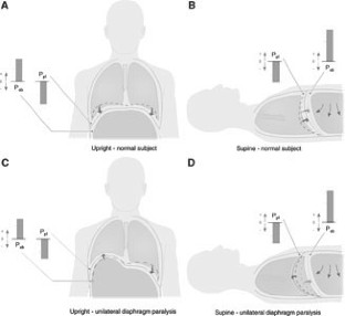 Diaphragm Paralysis Definitively Diagnosed by Ultrasonography and ...