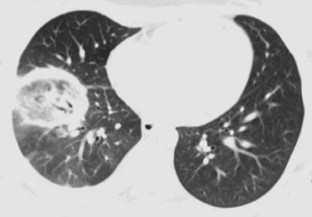Reversed Halo Sign on Computed Tomography: State-of-the-Art Review ...