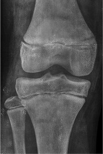 Response to commentary on “Radiographic analysis of epiphyseal fusion ...