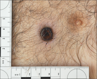 Arrow entrance wounds with blackened margins simulating bullet wipe ...