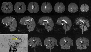 Clinical and MRI patterns of pericallosal artery infarctions: the ...