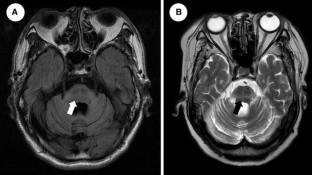 Diagnosis and differential diagnosis of MSA: boundary issues | SpringerLink