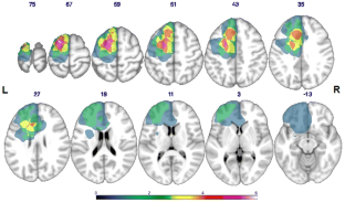 Role of the left frontal aslant tract in stuttering: a brain ...