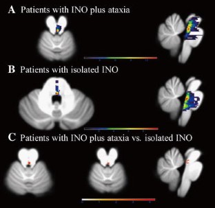 Internuclear ophthalmoplegia plus ataxia indicates a dorsomedial ...